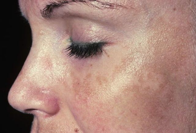 Should You Add Hydroquinone to Your Skin Care Routine - Dermatologists ...